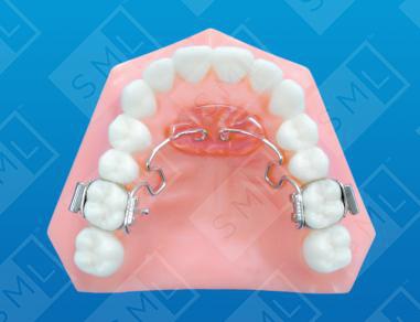 3D Nance Orthodontic Movement Dental Appliances SML Southwest 3D Nance Orthodontic Movement Dental Appliances SML Southwest
